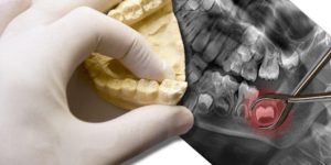 Wisdom Teeth 101: All You Need To Know About Wisdom Tooth Removal ...