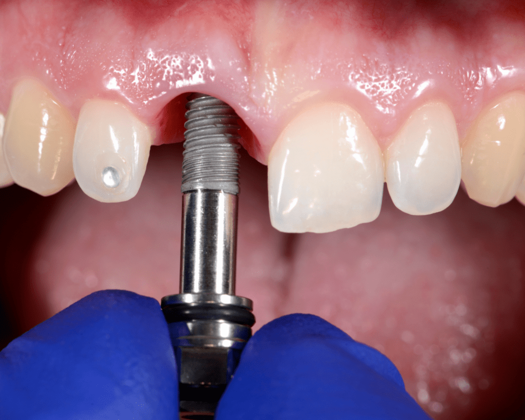 Dentures vs Implants: 5 Pros and Cons – Denticare